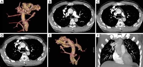 Arteriovenous Malformation Brain Avm Causes Symptoms Treatment