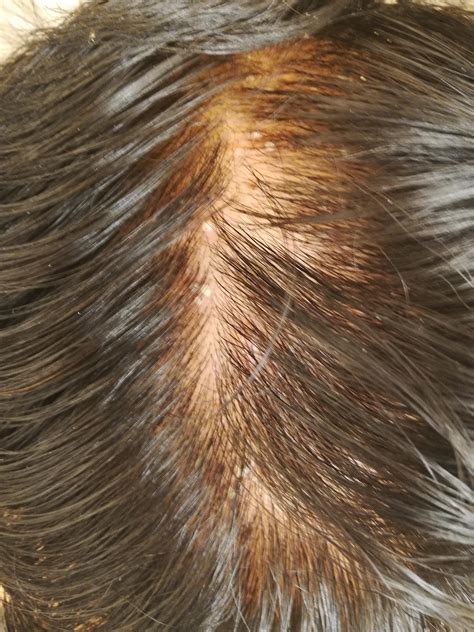 Pimplelike Bumps On The Scalp