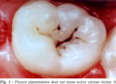 Figure 1 From Occlusal Caries Diagnosis And Treatment Semantic Scholar