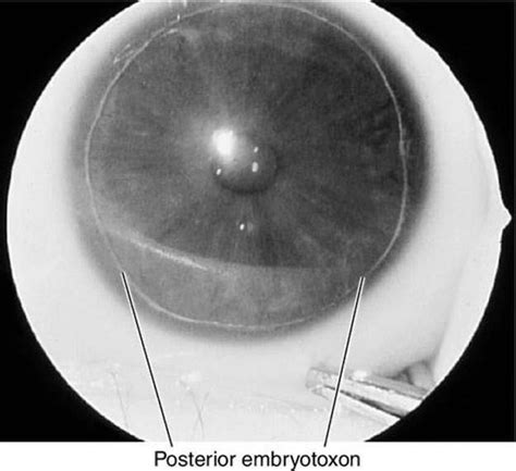 Posterior Embryotoxon Alagille Syndrome