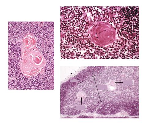 Thymic Corpuscle Hassalls Corpuscle Diagram Quizlet