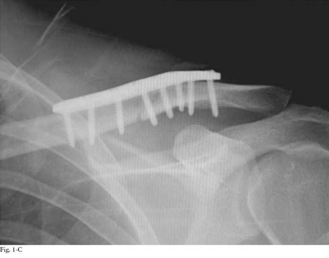 Figure 1 From Trial Midshaft Clavicular Fractures A Multicenter Randomized Clinical