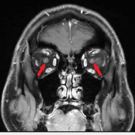 Mri Of The Orbits With Contrast Showing Subtle Uniform Enhancement Of
