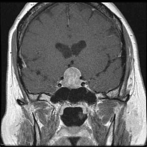 Brain Tumor Mris Kaggle