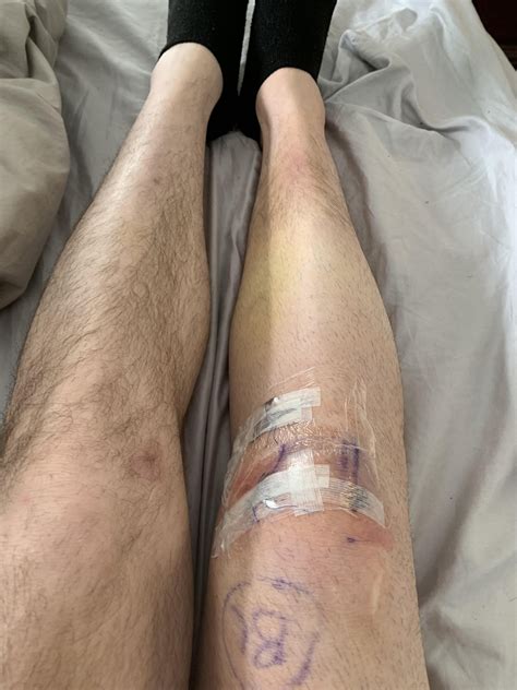 8 Weeks Post Op Bear Acl Repair Racl