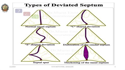 Deviated Nasal Septum And Its Managementpdf