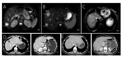 Frontiers Solid Pseudopapillary Neoplasm Of The Pancreas With Hepatic