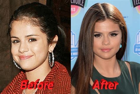 Selena Gomez Nose Job Before And After Rhinoplasty Photos