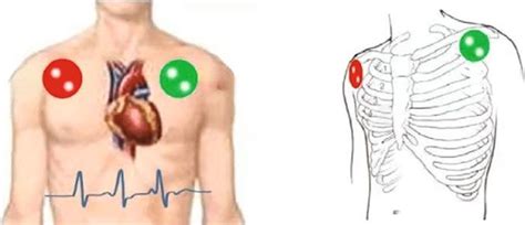 Electrocardiogram Signal Classification In The Diagnosis Of Heart