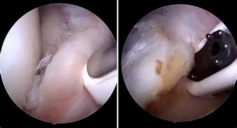 A Novel Arthroscopic Repair Method For Anterior Horn Of The Lateral