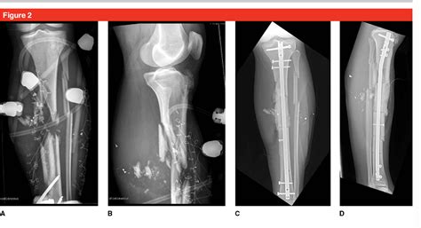 Figure 2 From Management Of Segmental Bone Defects Semantic Scholar