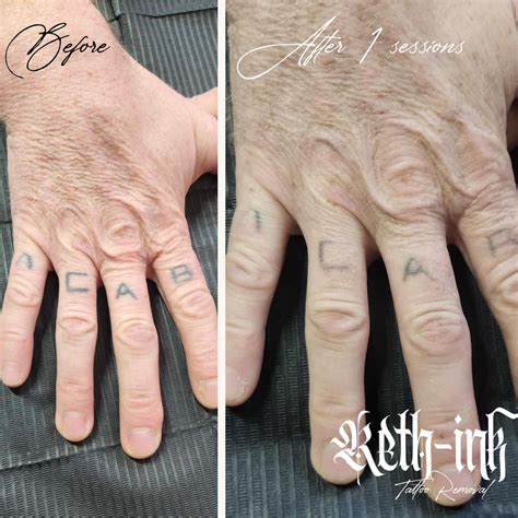 From Prison Ink To New Beginnings Why Tattoo Removal Can Be Empowering