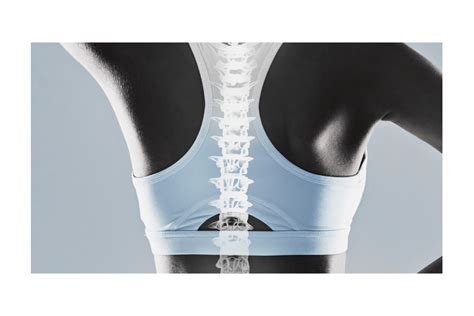 Thoracic Hyperkyphosis Innovations Physio And Pilates