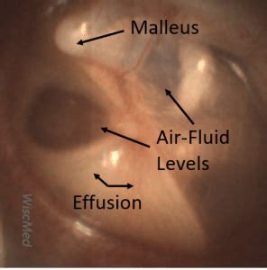 Middle Ear Effusion May 18 2023 Wiscmed