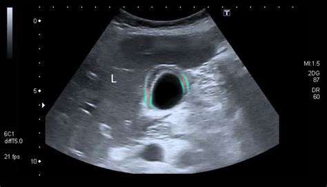 Chronic Cholecystitis Ultrasound