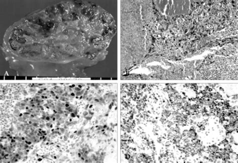 Choriocarcinoma Gross Image