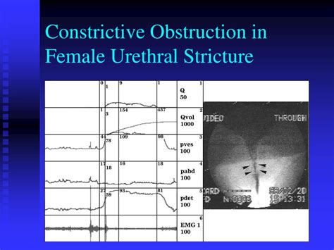Ppt Urodynamics And Bladder Outlet Obstruction Powerpoint Presentation Id 1356300