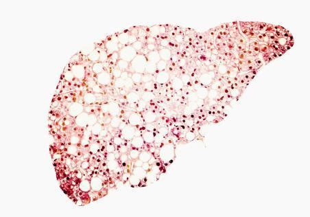 范建高教授：亚洲nafld Mafld的流行趋势和临床特征 患者 肥胖 相关 亚洲 患病率 健康界