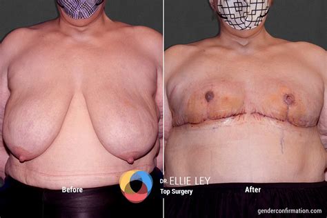 Inverted T Gender Confirmation