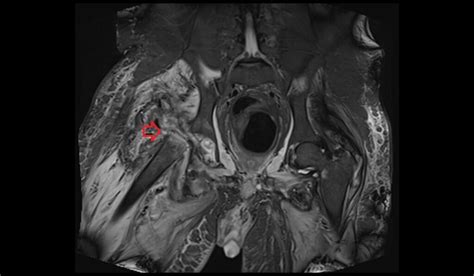 Mri Pelvis Pathologies How To Report An Mri Pelvis Scan