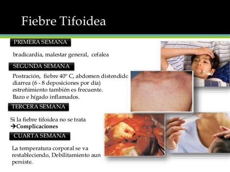 Sintomas De Fiebre Tifoidea Es Contagiosa Yvdl