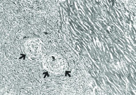 Microscopic Findings Show Marked Lymphoid Proliferation With Distinct Download Scientific