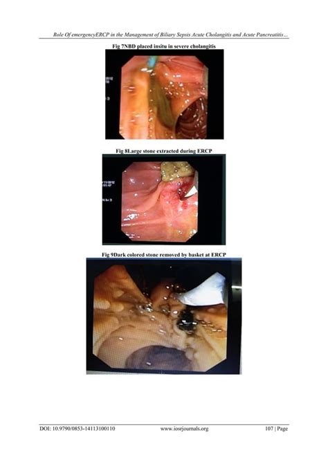 Role Of Emergency Ercp In The Management Of Biliary Sepsis Acute