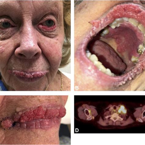 A To C Involving The Lower Portion Of The Left Eyelid Margin Upper