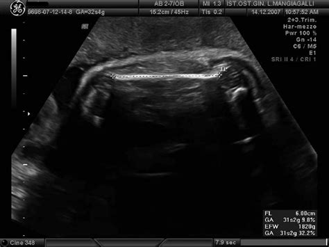 Longitudinal Sonogram Of The Fetal Femur Length Download Scientific