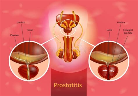 Prostatitis Realistic Vector Medical Scheme Stock Vector Illustration