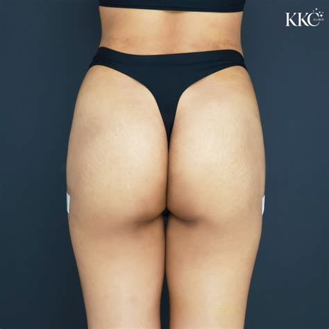 Hip Dip Filler In Bangkok With Variofill