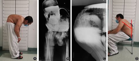A Preoperative Clinical Photograph Showed The As Patient 2 With