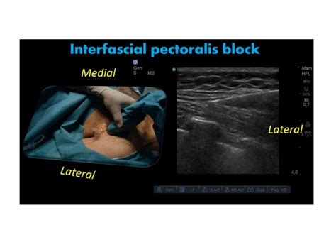 Pec I And Pecs Ii Serratus Anterior Block
