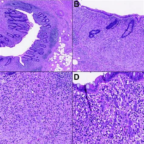 Fibrous Obliteration Of The Appendix A Central Obliterative Lesion