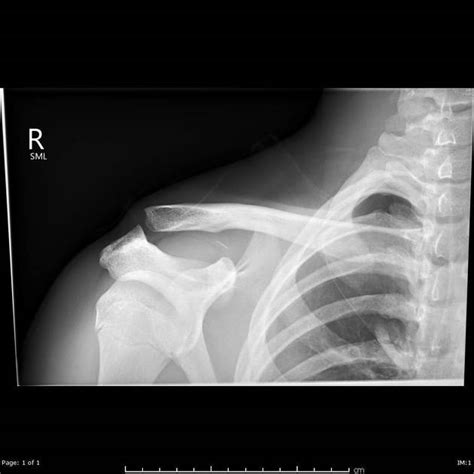 Coracoid Process Fracture Pacs