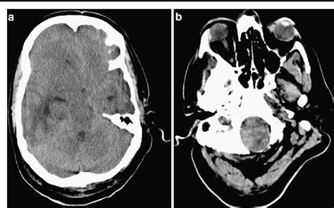 Localized Abscess Comprehensive Guide To Diagnosis Treatment And