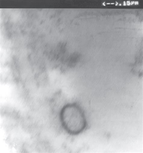 Figure 4 From Calcifying Nanoparticles Associated Encrusted Urinary Bladder Cystitis Semantic