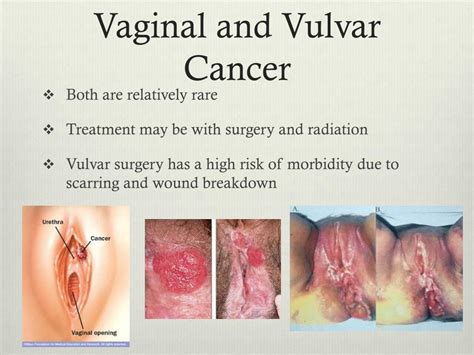 Vaginal Cancer