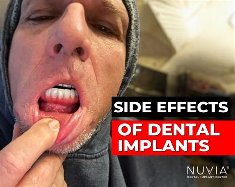 Patients Unfiltered Review Of The Side Effects Of Dental Implants