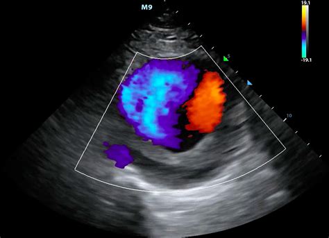 Ultrasound Physics Quizlet At Mary Wilber Blog