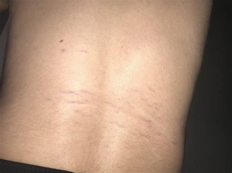 Back Bruising R Medical