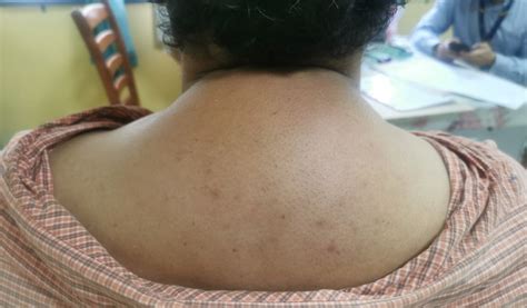 Síndrome De Cushing O Que é Causas E Sintomas Blog Nav Dasa