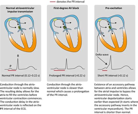 P Wave Pr Interval Pr Segment Physiology Criteria And Ecg Findings