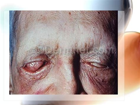 Leprosy Ppt