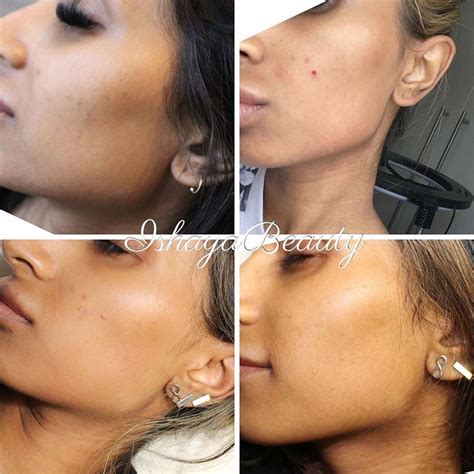 Bb Glow Before And After Pictures Gallery Best Examples