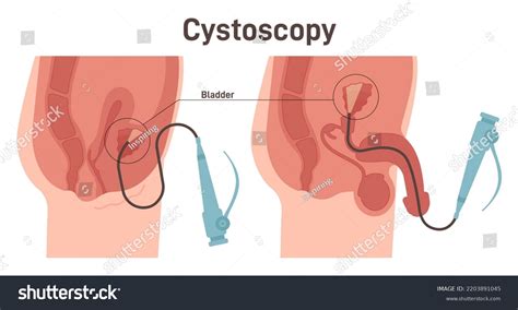 Cystoscopy Set Male Female Bladder Surface Stock Vector Royalty Free