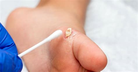Pediatrics Warts