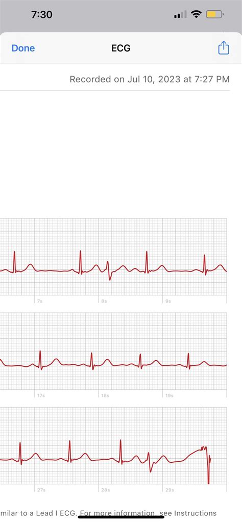 No Compensatory Pause R Readmyecg