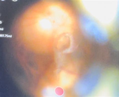 Vitrectomy For Floaters More Common