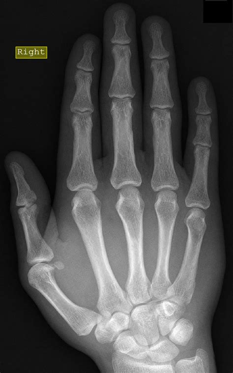 Broken Metacarpal X Ray Broken Metacarpal X Ray